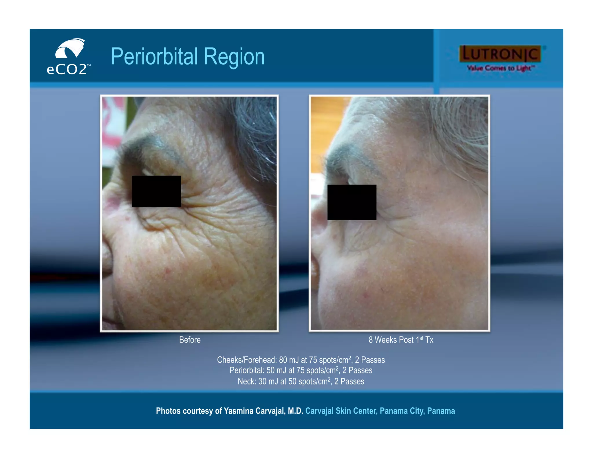 eCO2 Fractional Before After Photos | PDF