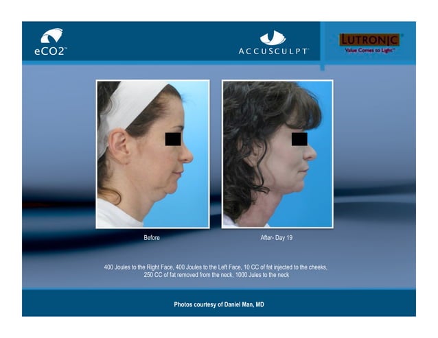 eCO2 Fractional Before After Photos | PDF | Skin and Dermatology | Diseases and Conditions