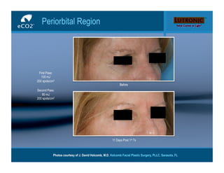 eCO2 Fractional Before After Photos | PDF