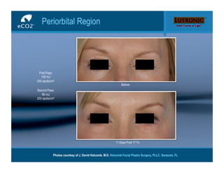eCO2 Fractional Before After Photos | PDF