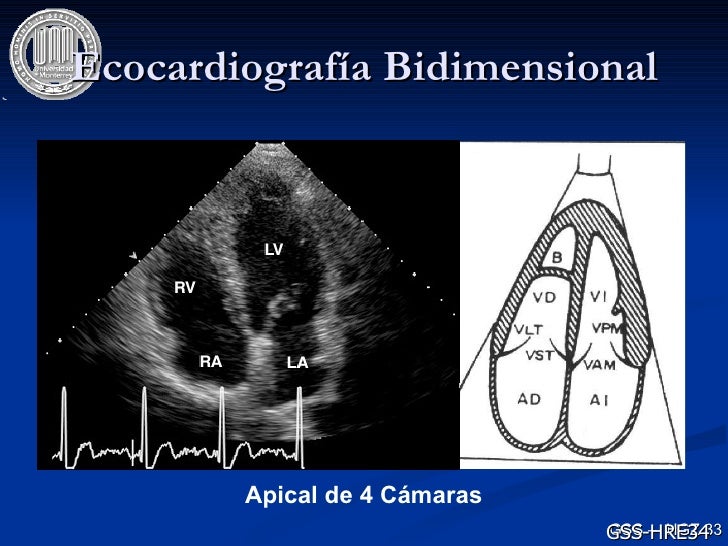 Ecocardiografía