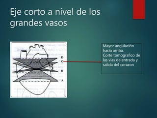 Ecocardiografía bidimensional | PPTX