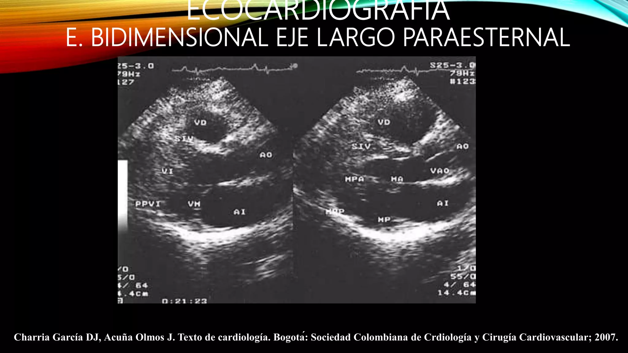 Ecocardiografia modo m, bidimensional y doppler color | PPTX