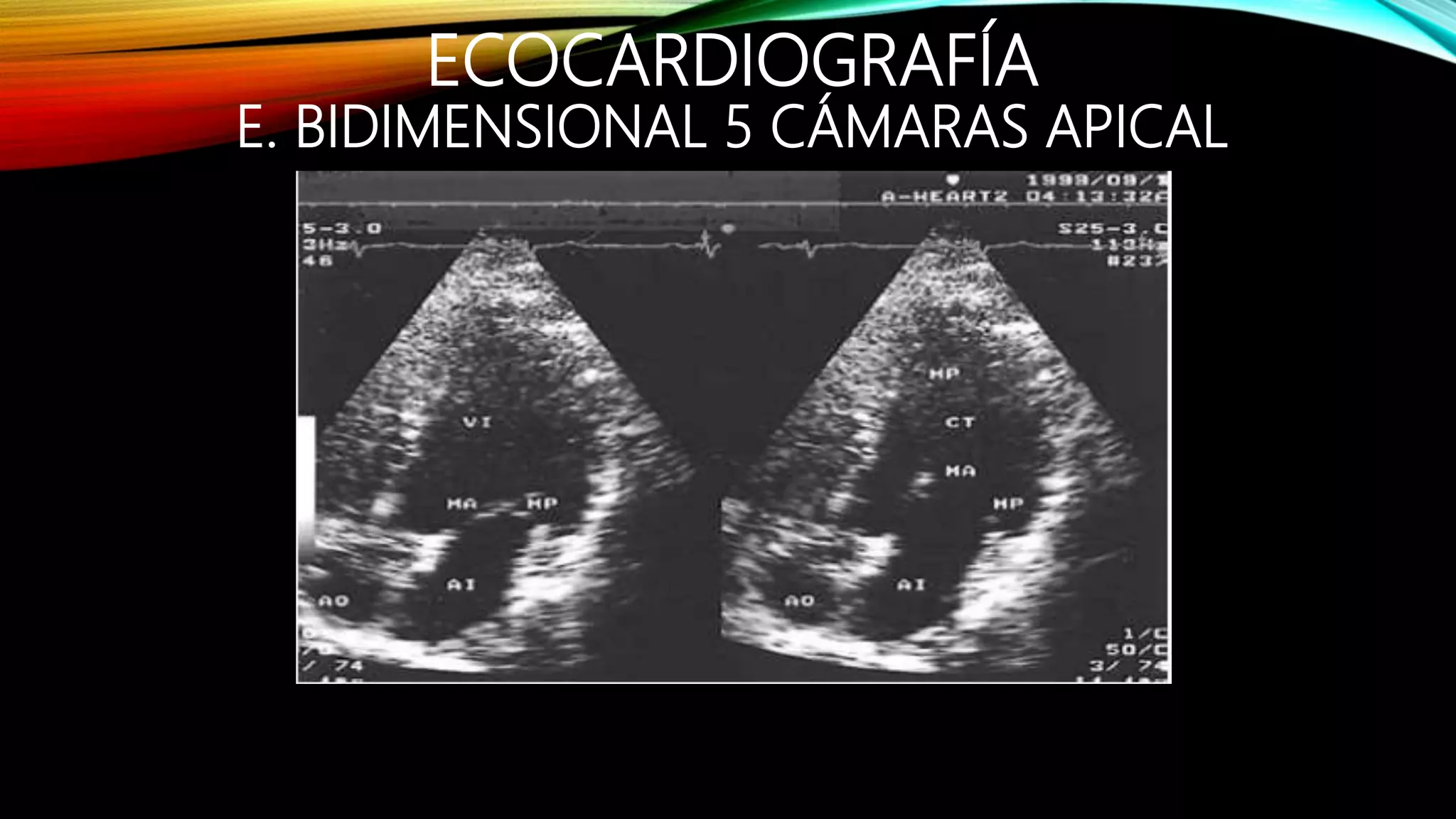 Ecocardiografia modo m, bidimensional y doppler color | PPTX