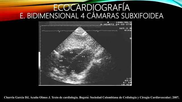 Ecocardiografia modo m, bidimensional y doppler color | PPTX