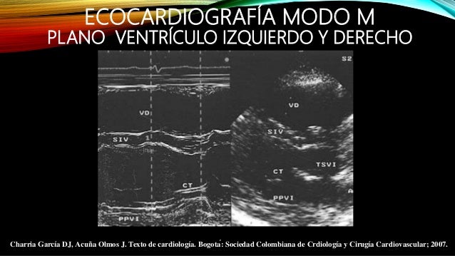 Ecocardiografia modo m, bidimensional y doppler color