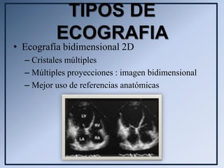 Ecocardiografia Transesofagica | PPTX