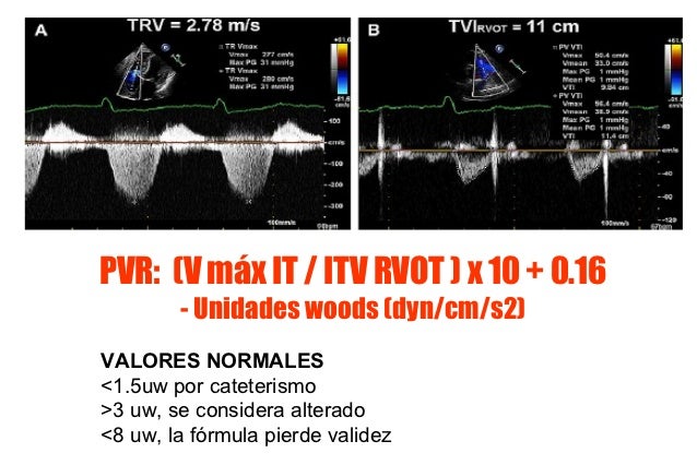 Ecocardiografía, Función sistólica del ventrículo derecho y embolia p…