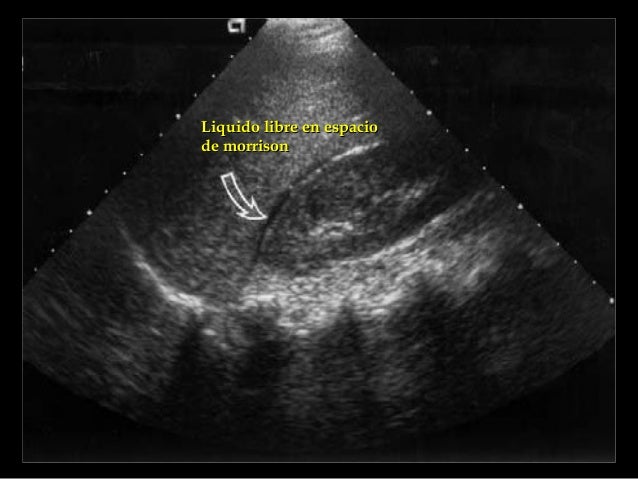 Eco fast y tac en trauma cerrado de abdomen