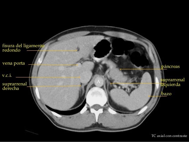 Eco fast y tac en trauma cerrado de abdomen
