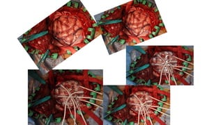 Electrocorticography of the Brain during Surgery | PPTX