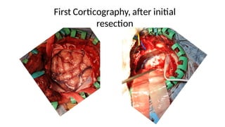 Electrocorticography of the Brain during Surgery | PPTX