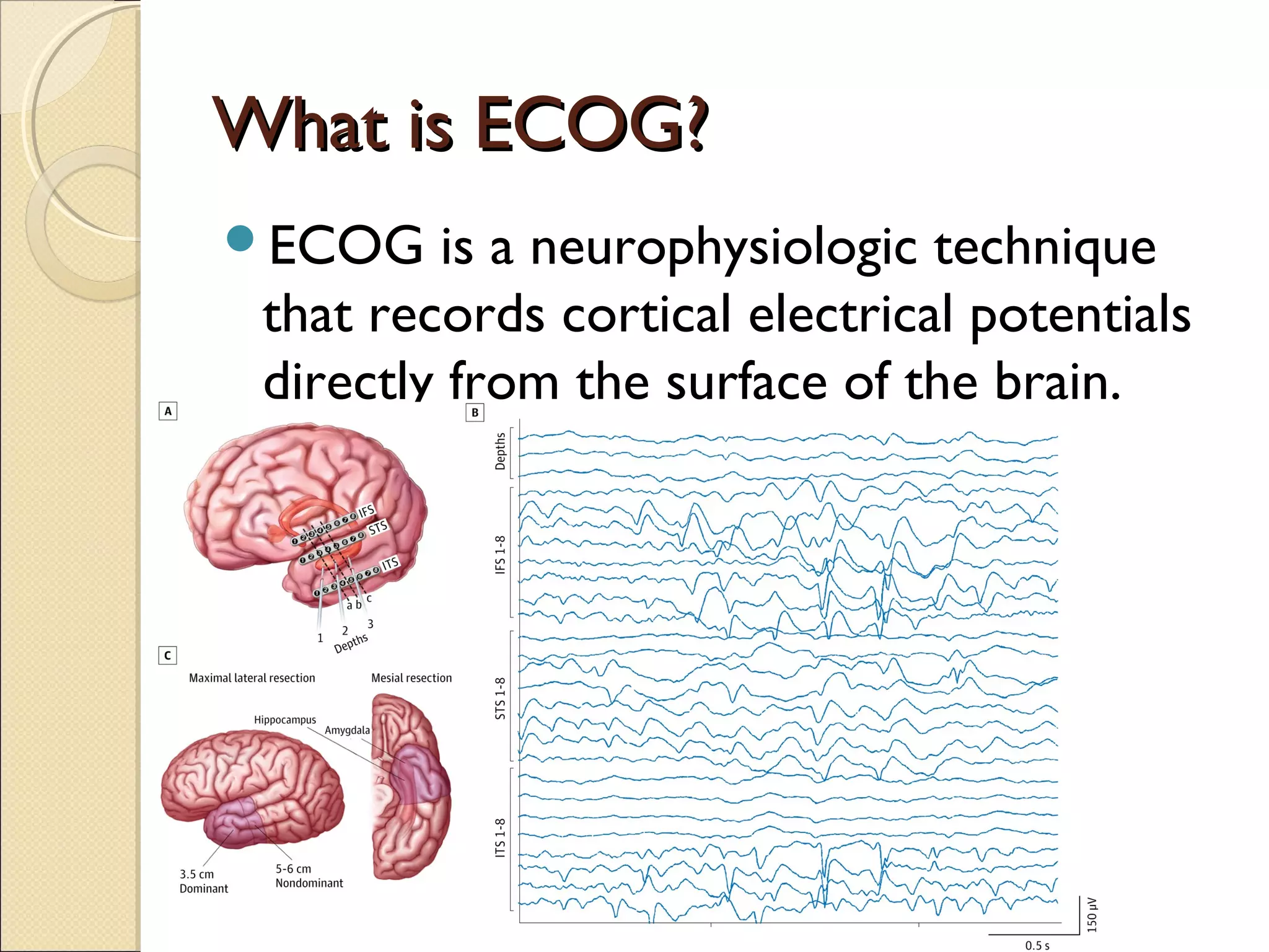 Electrocorticography | PPT