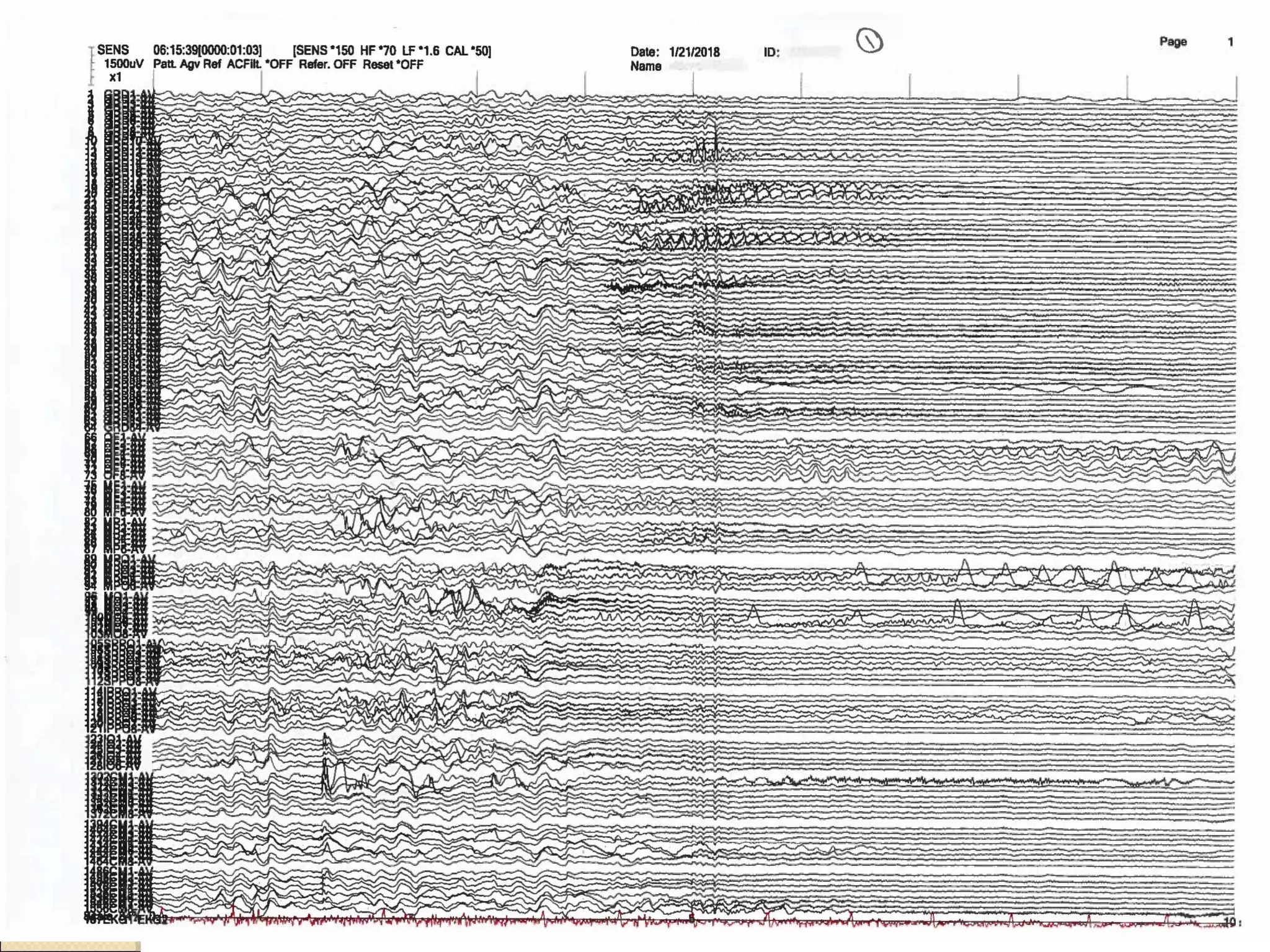 Electrocorticography | PPT