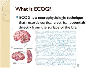 Electrocorticography | PPT