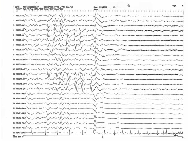 Electrocorticography | PPT | Brain and Nervous System Disorders | Diseases and Conditions