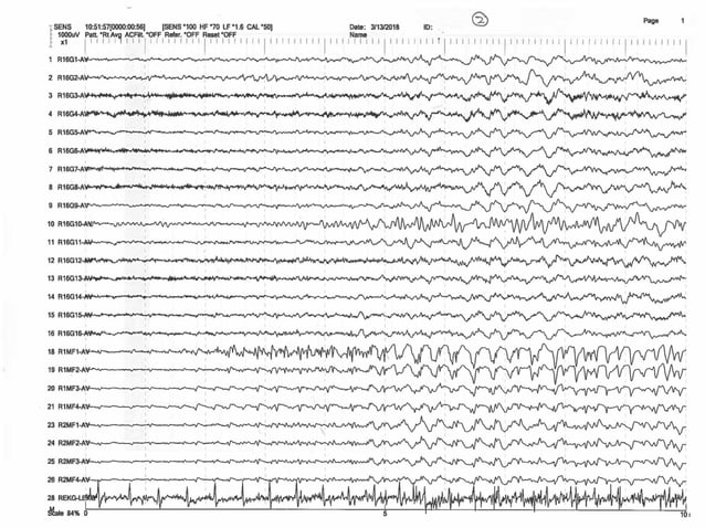 Electrocorticography | PPT | Brain and Nervous System Disorders ...