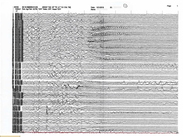 Electrocorticography | PPT | Brain and Nervous System Disorders | Diseases and Conditions