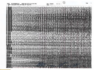 Electrocorticography | PPT