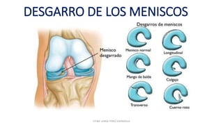 ECOGRAFÍA DE MENISCOS DE RODILLA.pptx