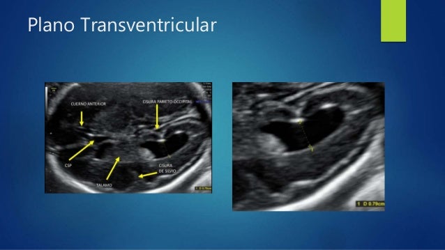 Ecografía morfológica