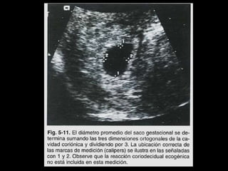 Ecografía obstétrica normal xav | PPTX