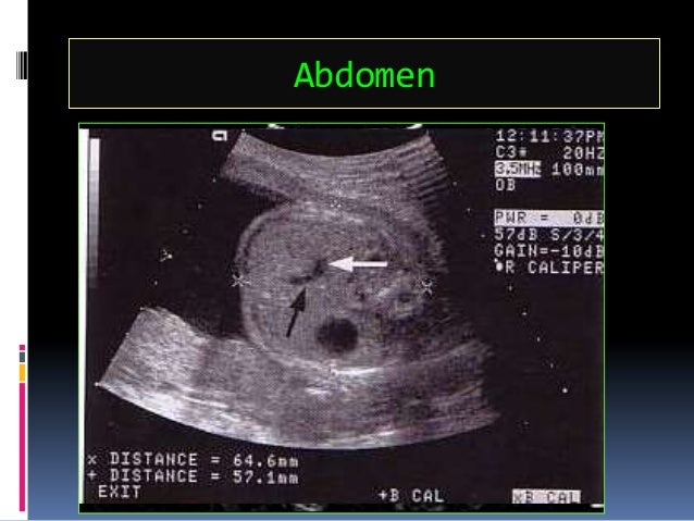 Ecografia abdominal fetal