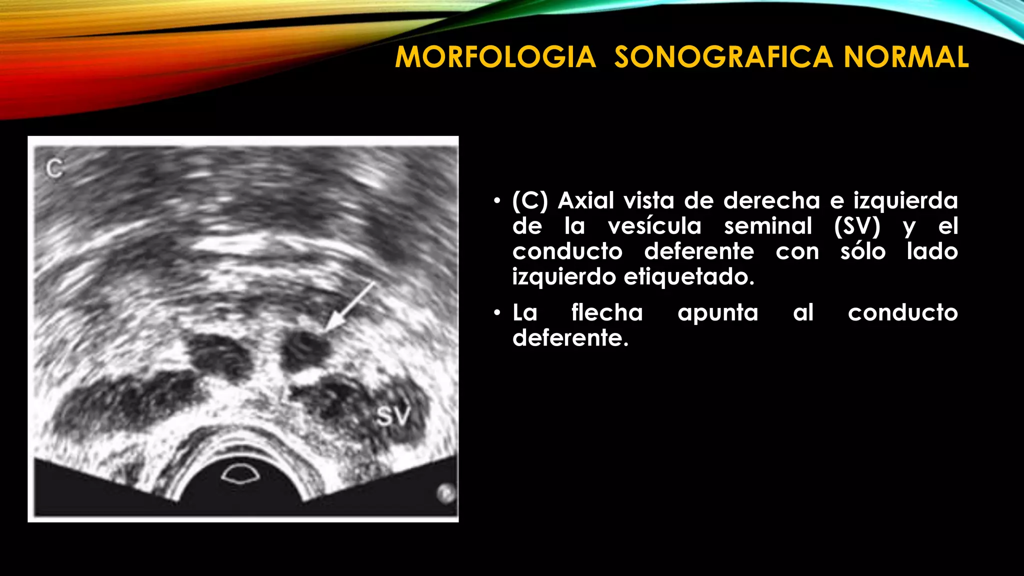 Ecografia cancer prostata | PPT | Medical Tests | Medical Health