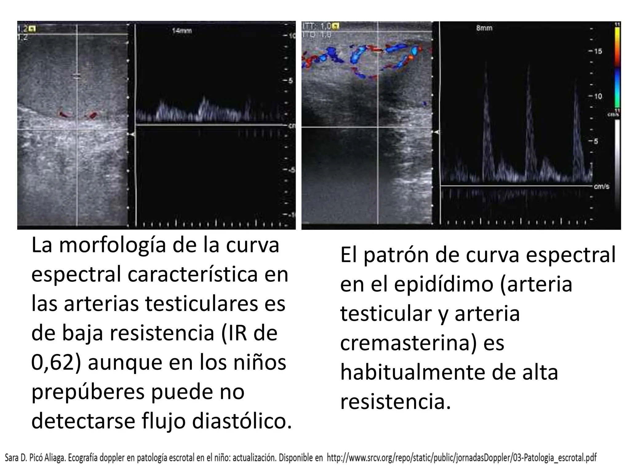 ecografia_clinica_en_patologia_escrotal_y_testicular_en_ninos_y ...