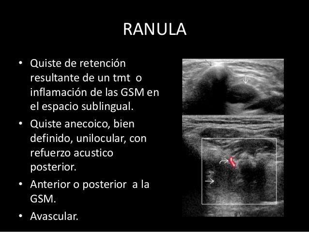 Ecografia de cuello en ecografia.