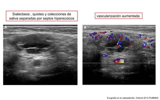 ECOGRAFIA DE LAS GLANDULAS SALIVALES.pptx