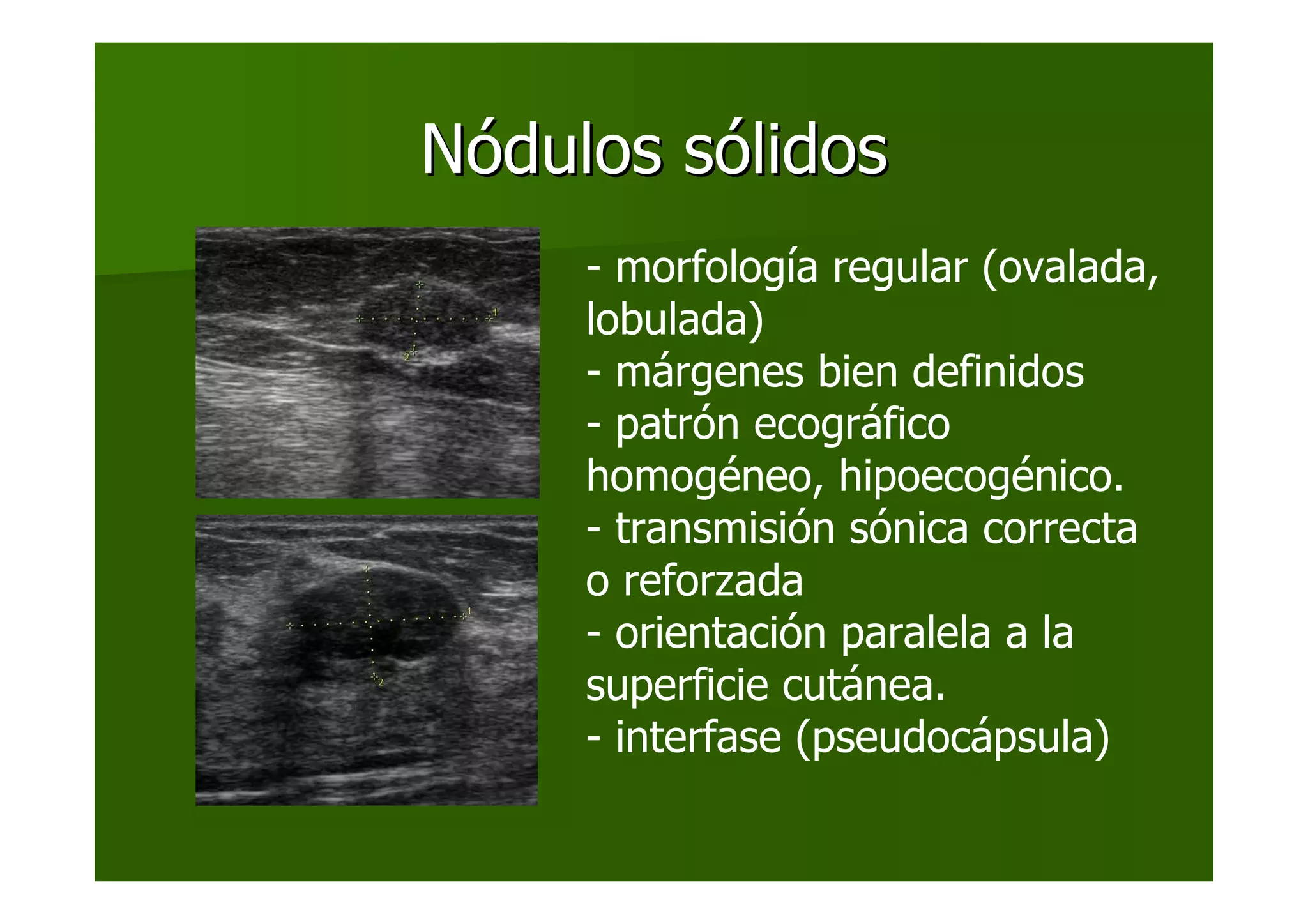 Ecografia de mama en atención primaria | PDF