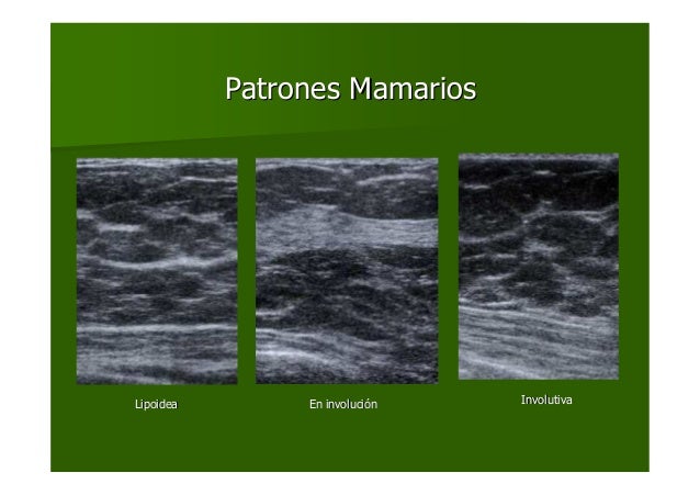 Ecografia de mama en atención primaria