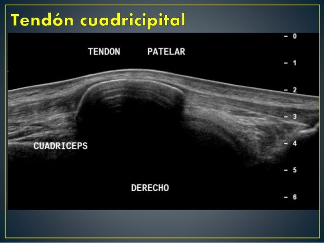Ecografia de rodilla