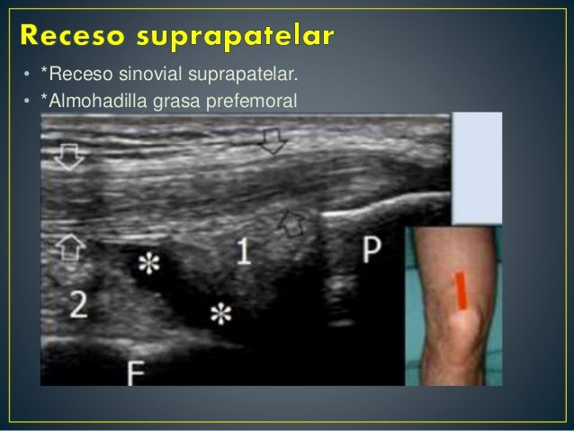 Ecografia de rodilla