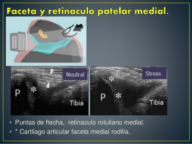 Ecografia de rodilla