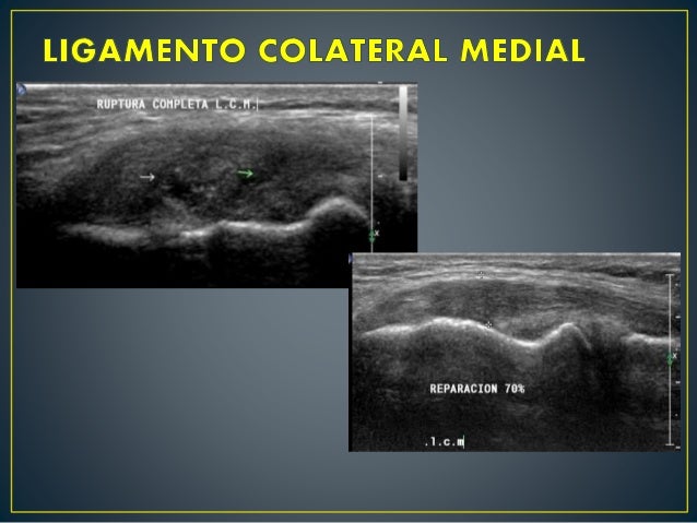 Ecografia de rodilla