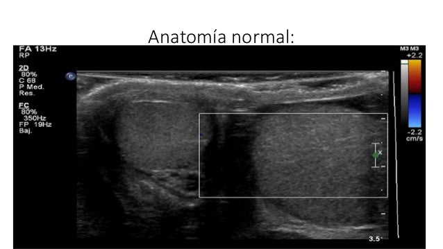 Ecografía de testículo