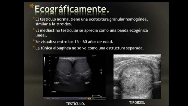 Ecografía De Testículo