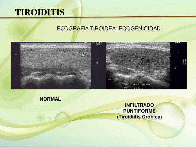 Ecografia de tiroides