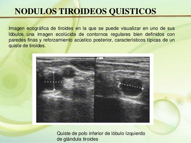 Ecografia de tiroides