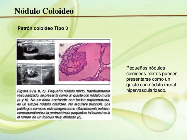 Ecografia de tiroides