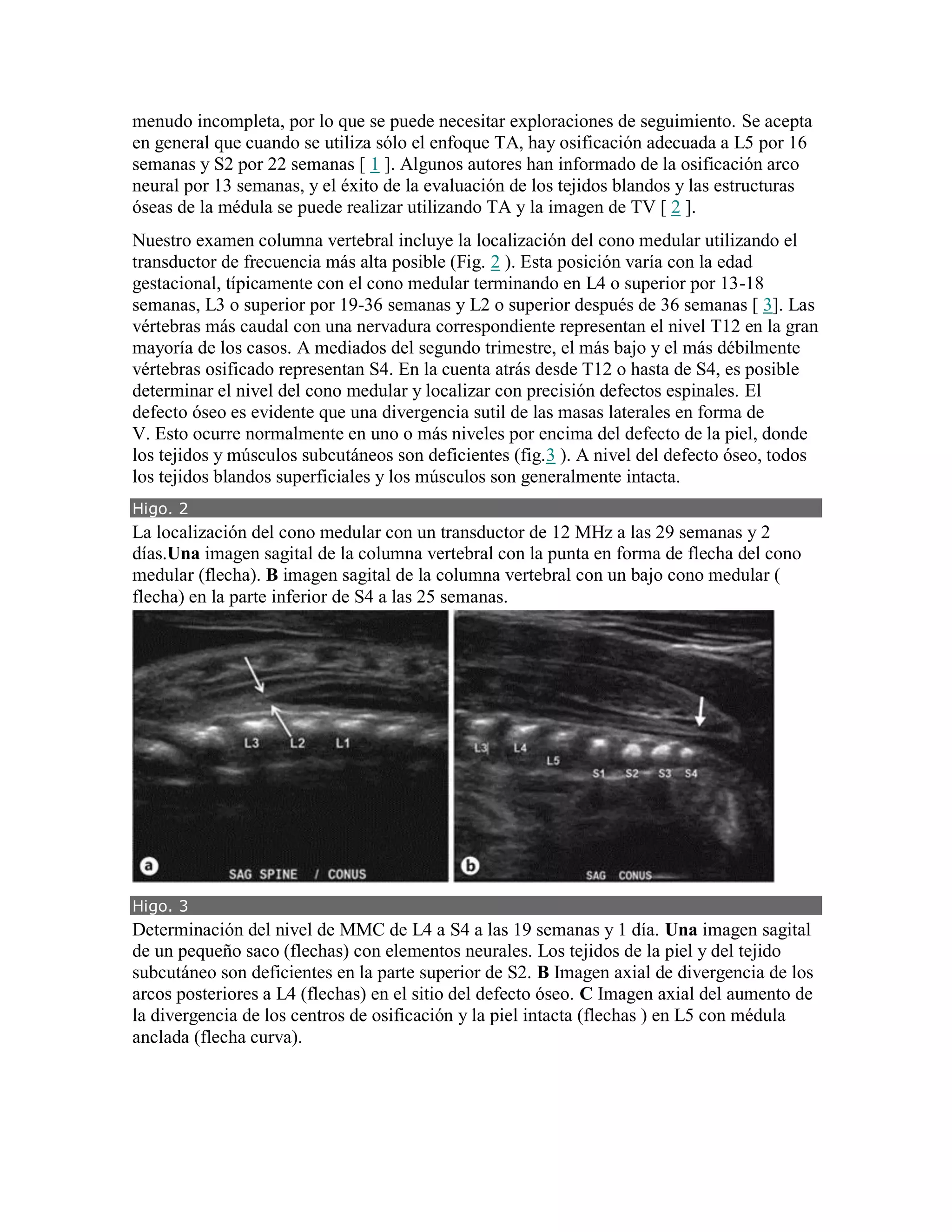 Ecografia fetal en la espina bifida | PDF | Pregnancy | Reproductive Health