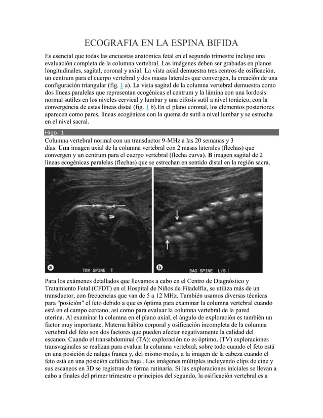 Ecografia fetal en la espina bifida | PDF | Pregnancy | Reproductive Health