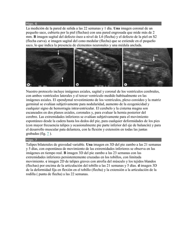 Ecografia fetal en la espina bifida | PDF | Pregnancy | Reproductive Health