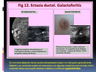 ECOGRAFIA MAMARIA, DRA VIRGINIA CENTELLAS.pptx