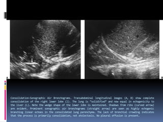ecografia_pulmonar.ppt