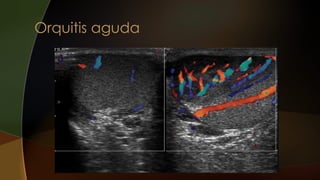 ECOGRAFIA TESTICULAR principios basicos y casos clinicos | PPTX