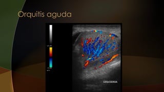 ECOGRAFIA TESTICULAR principios basicos y casos clinicos | PPTX