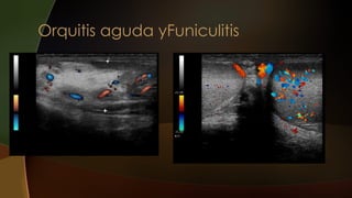 ECOGRAFIA TESTICULAR principios basicos y casos clinicos | PPTX